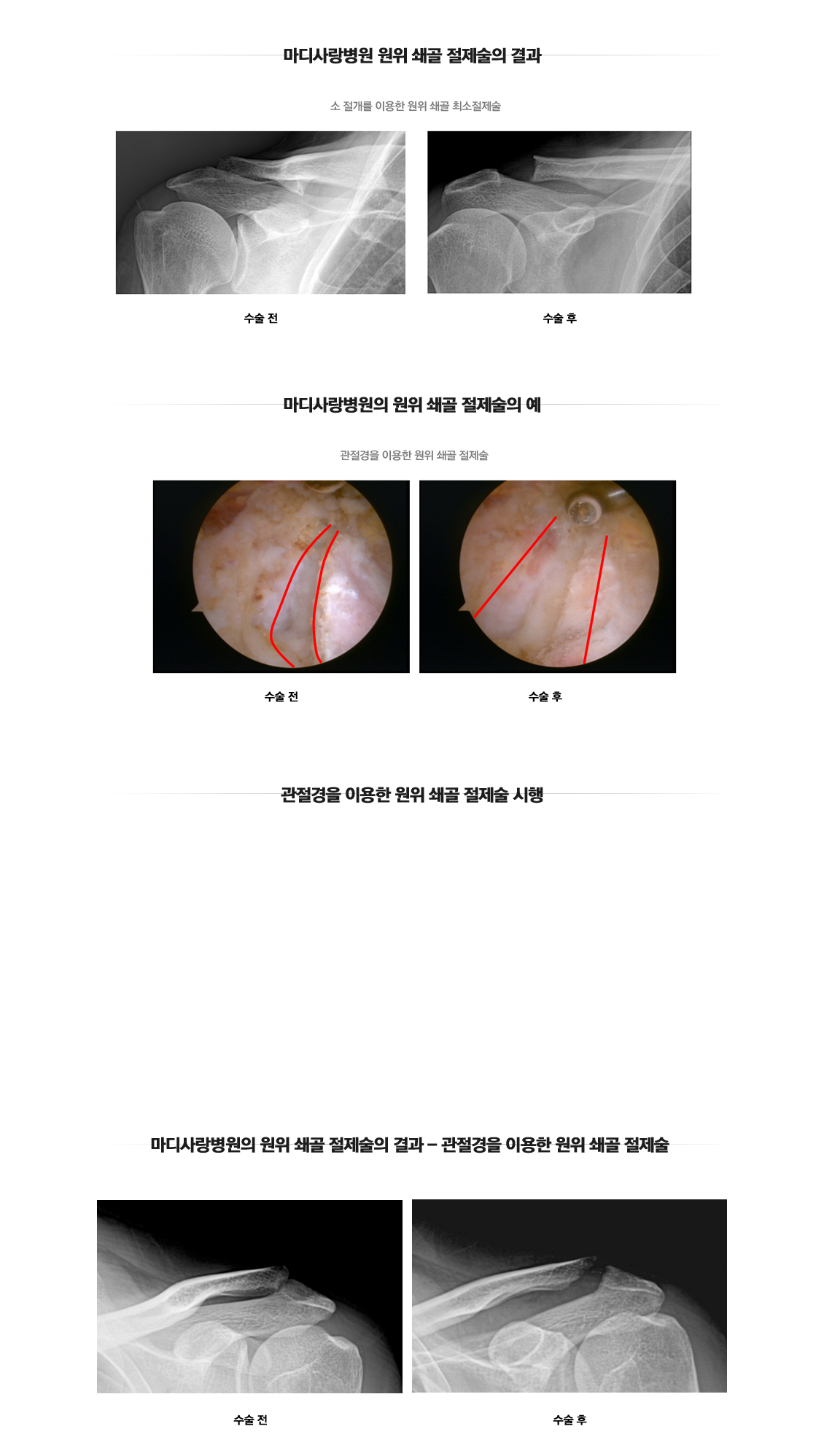 마디사랑병원 - Surgeries > Shoulder Surgery > 원위 쇄골 절제술